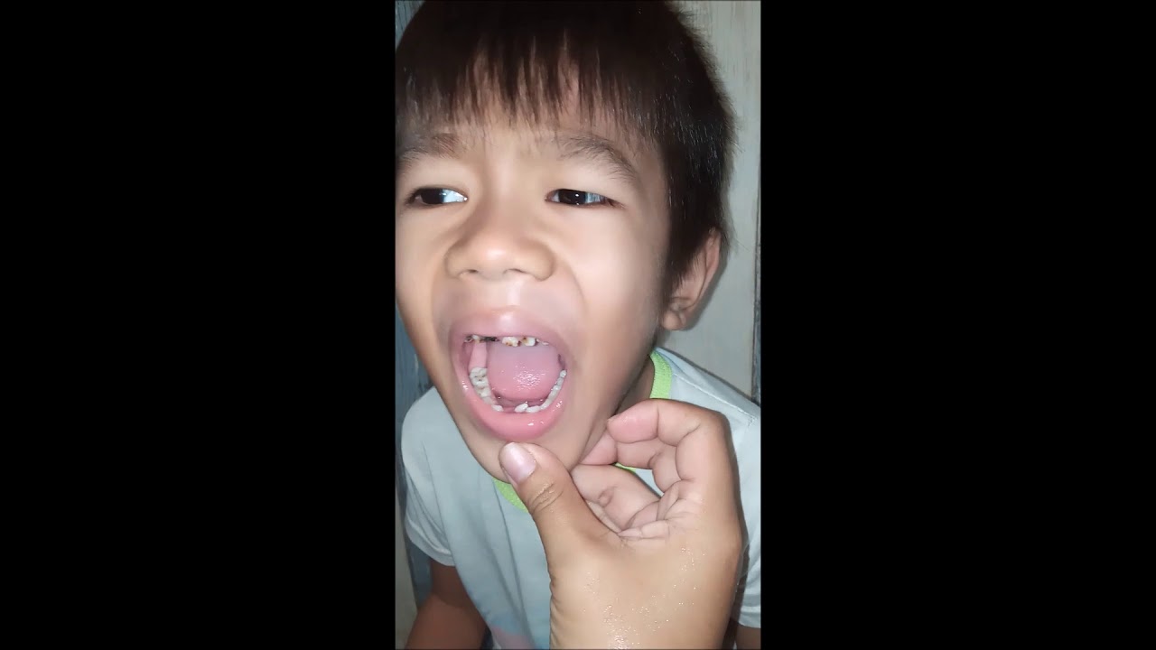 Cabut Gigi Anak secara Manual - YouTube