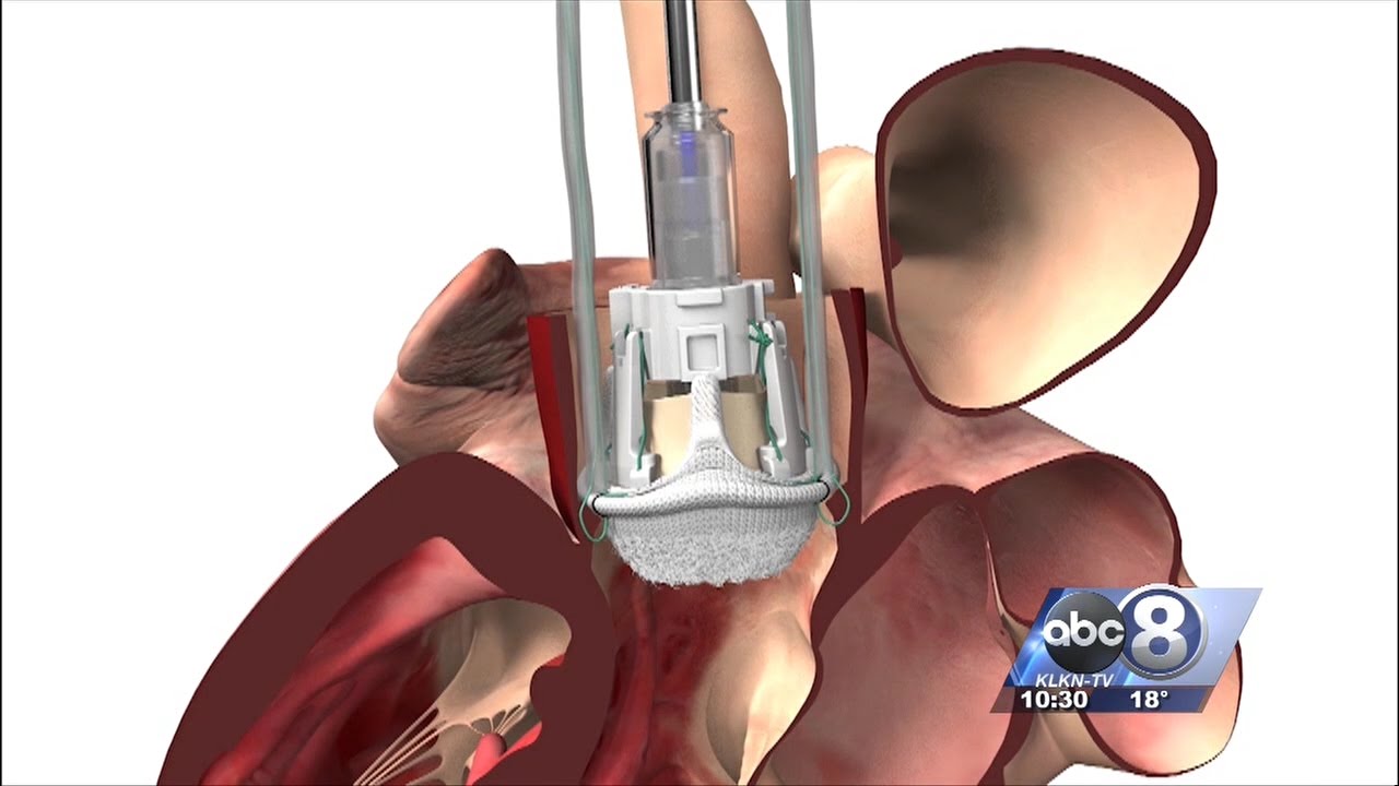 Second Sunday Bryan Health Report: Edwards Intuity Valve - YouTube