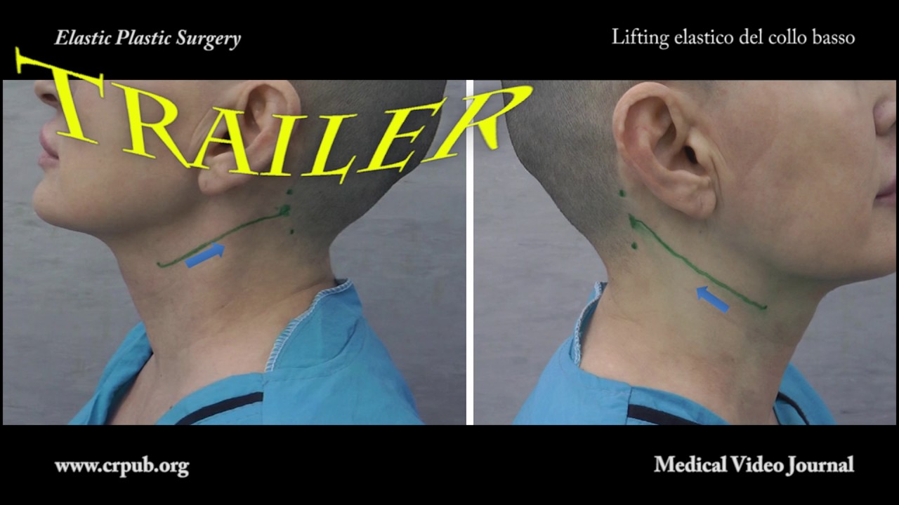 36. Lifting elastico del collo basso TRAILER - YouTube