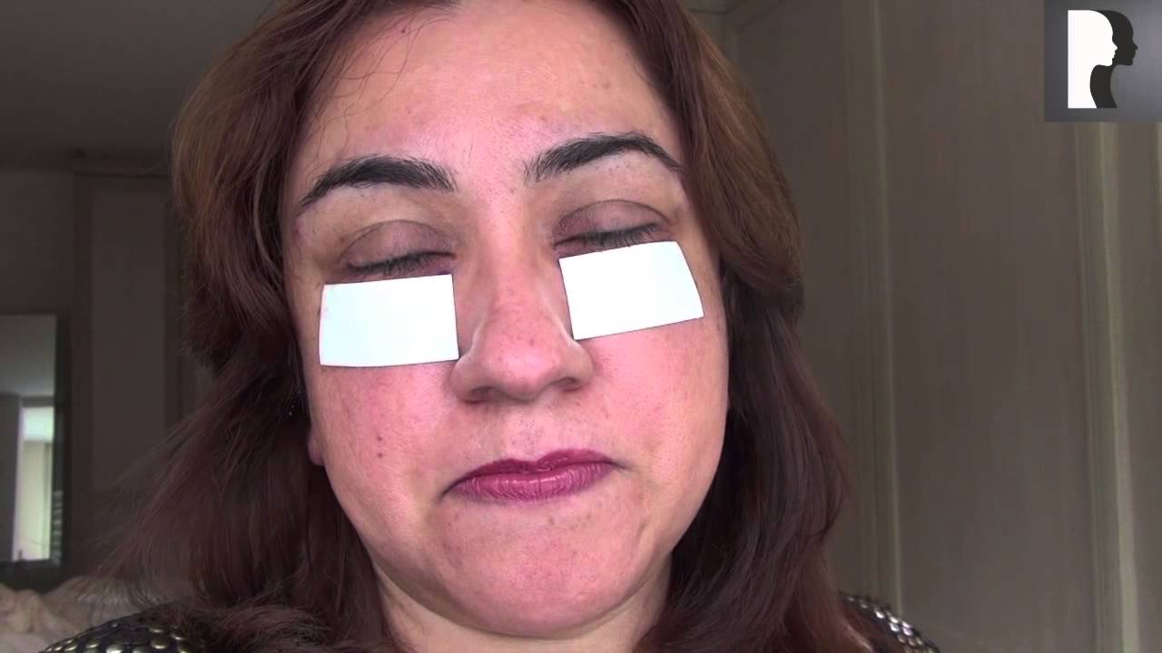 Blepharoplasty Video Diary: Day 1 After Surgery & Recovery Progress ...