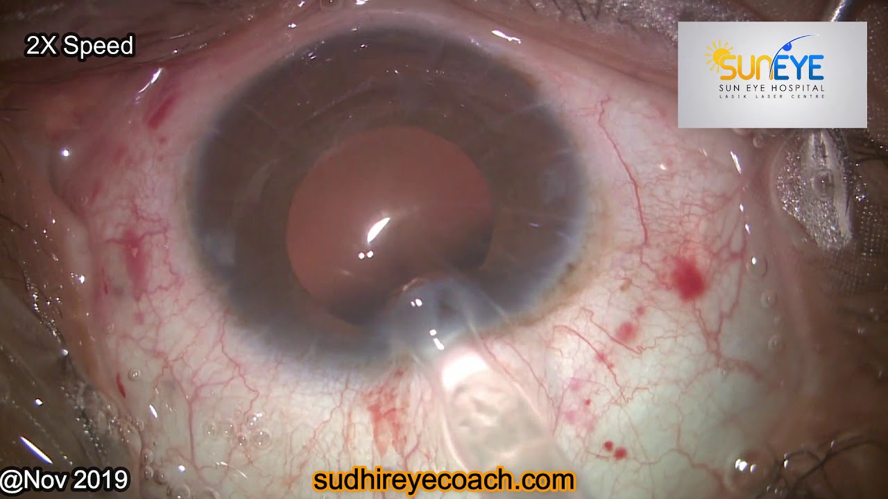 Femto-Cataract (FLACS) in Patient with Radial Keratotomy (RK) Incisions ...