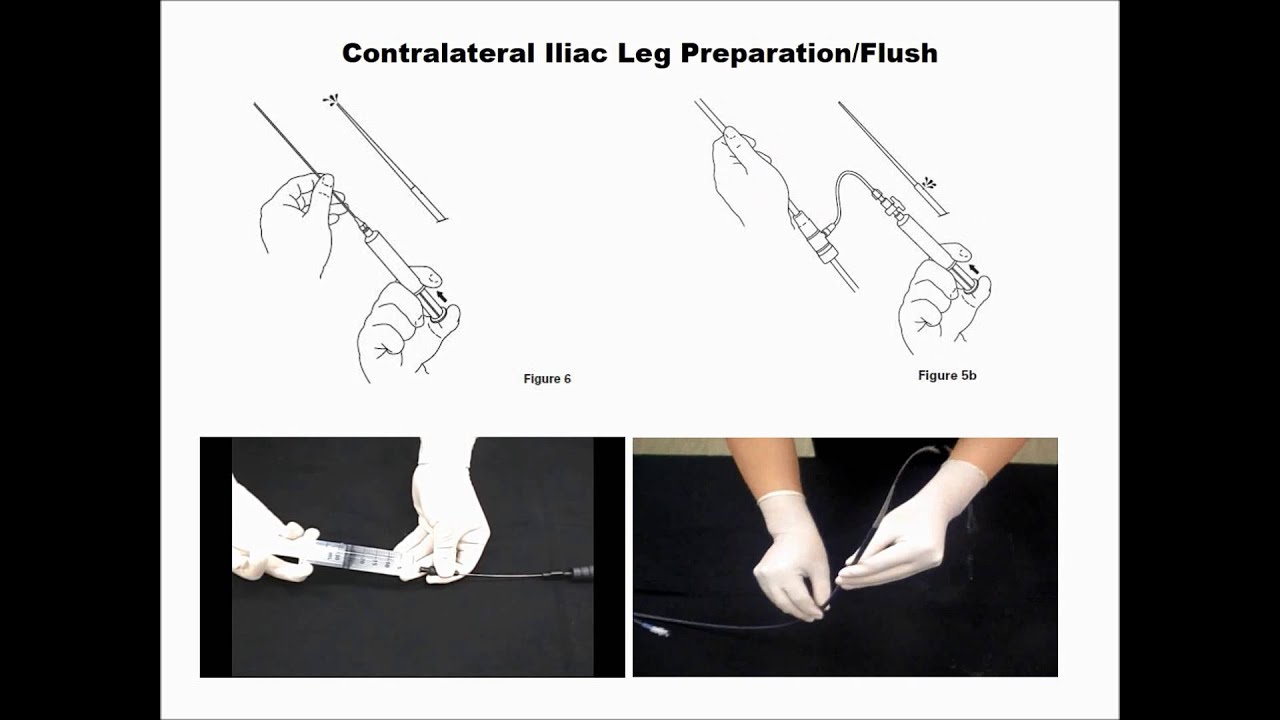 Physician reference manual EVAR of COOK Zenith AAA endovascular graft ...