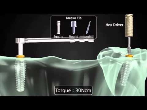 Kerator Overdenture System - YouTube