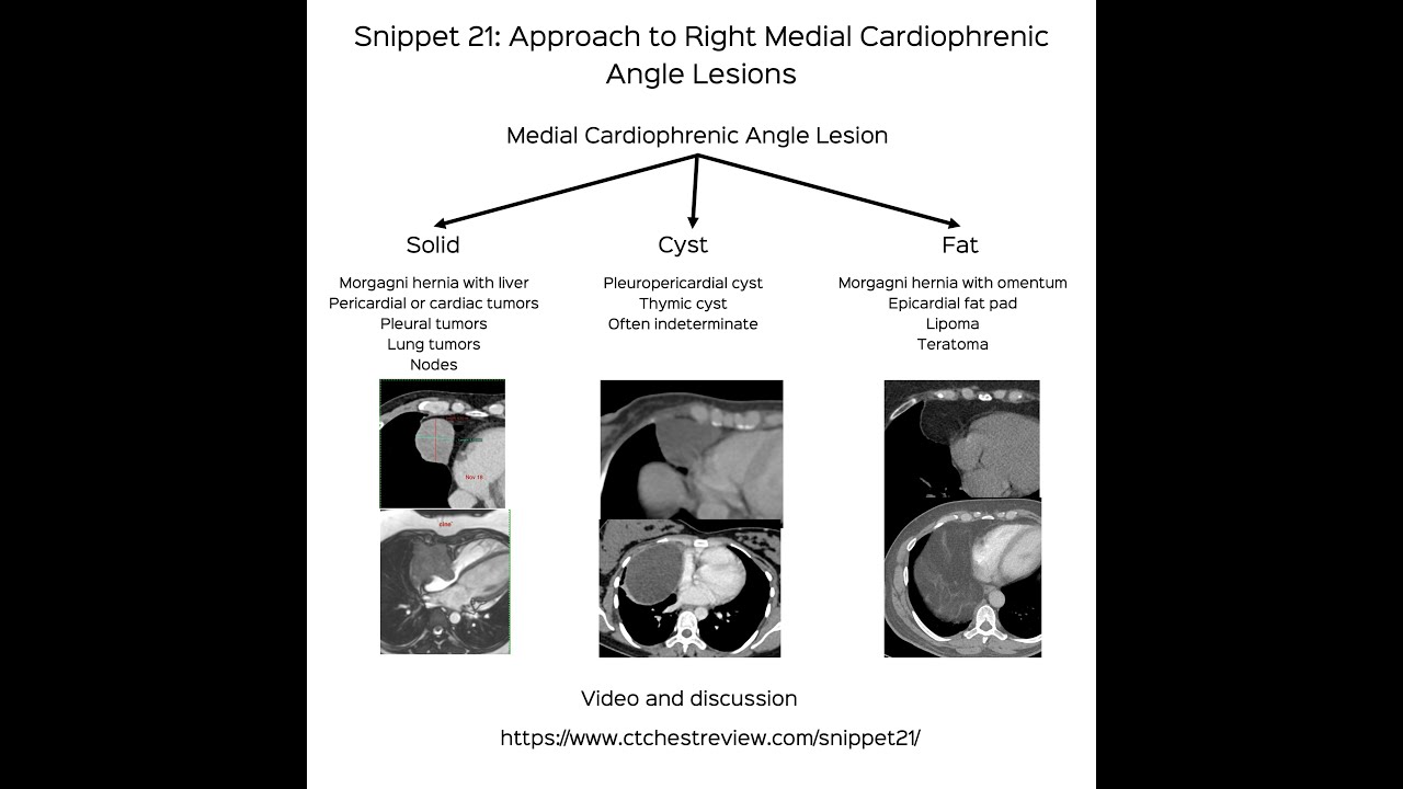 Snippet 21 Approach to Right Medial Cardiophrenic Angle Lesions - YouTube