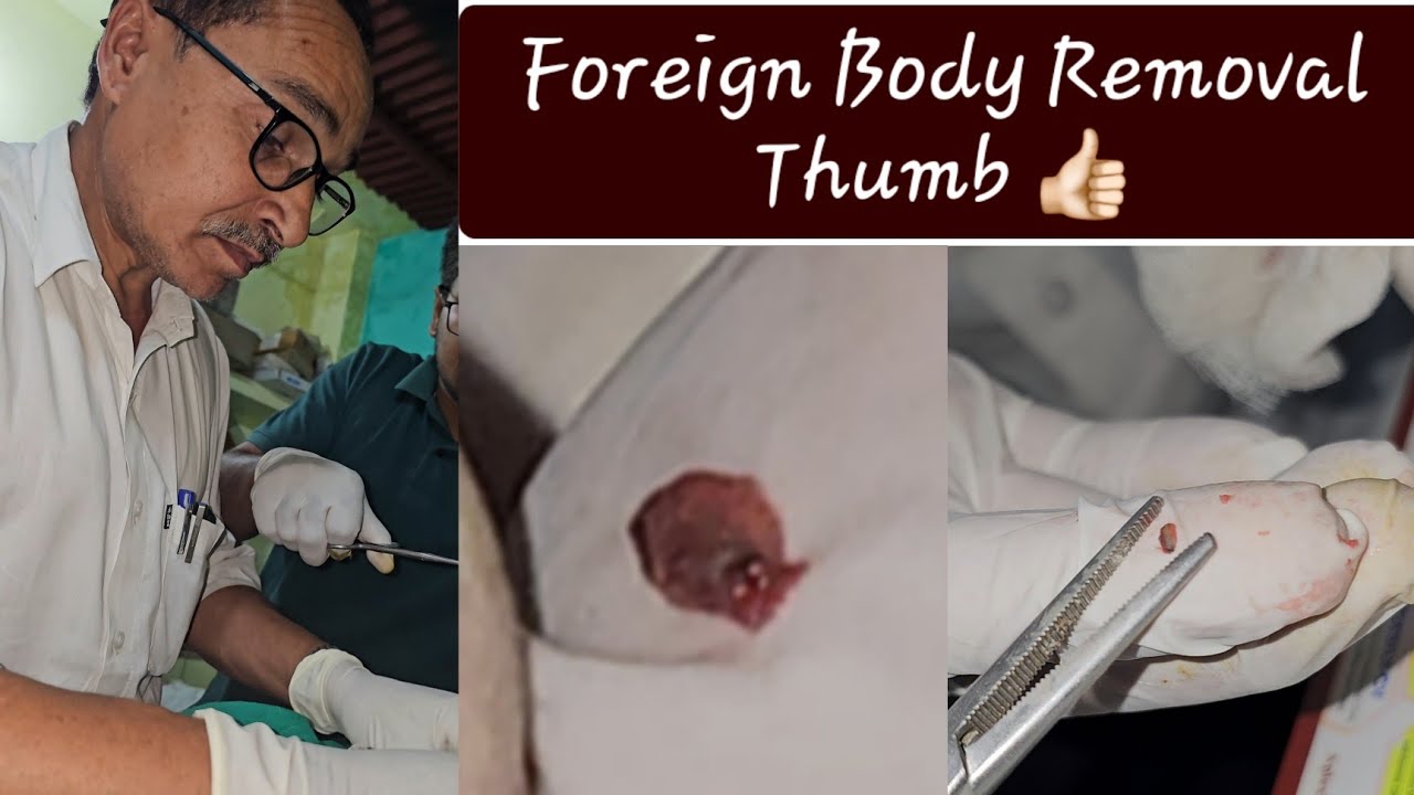 Foreign Body Removal from Thumb | Bamboo Stick Injury | Al Haider ...