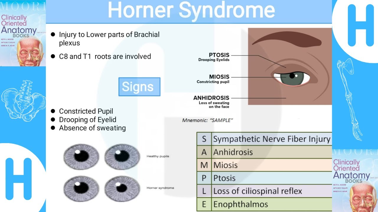 Horner Syndrome:Clinical manifestations, diagnosis and management - YouTube
