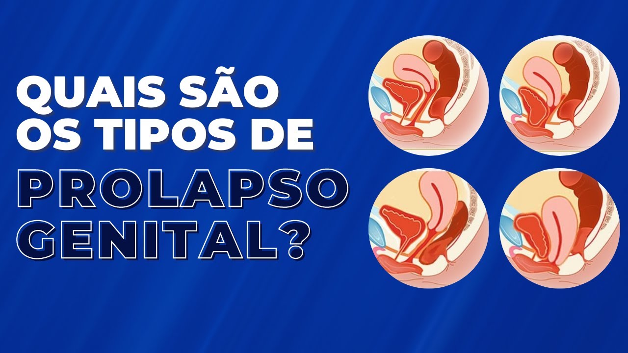 Quais são os tipos de prolapso genital? - YouTube