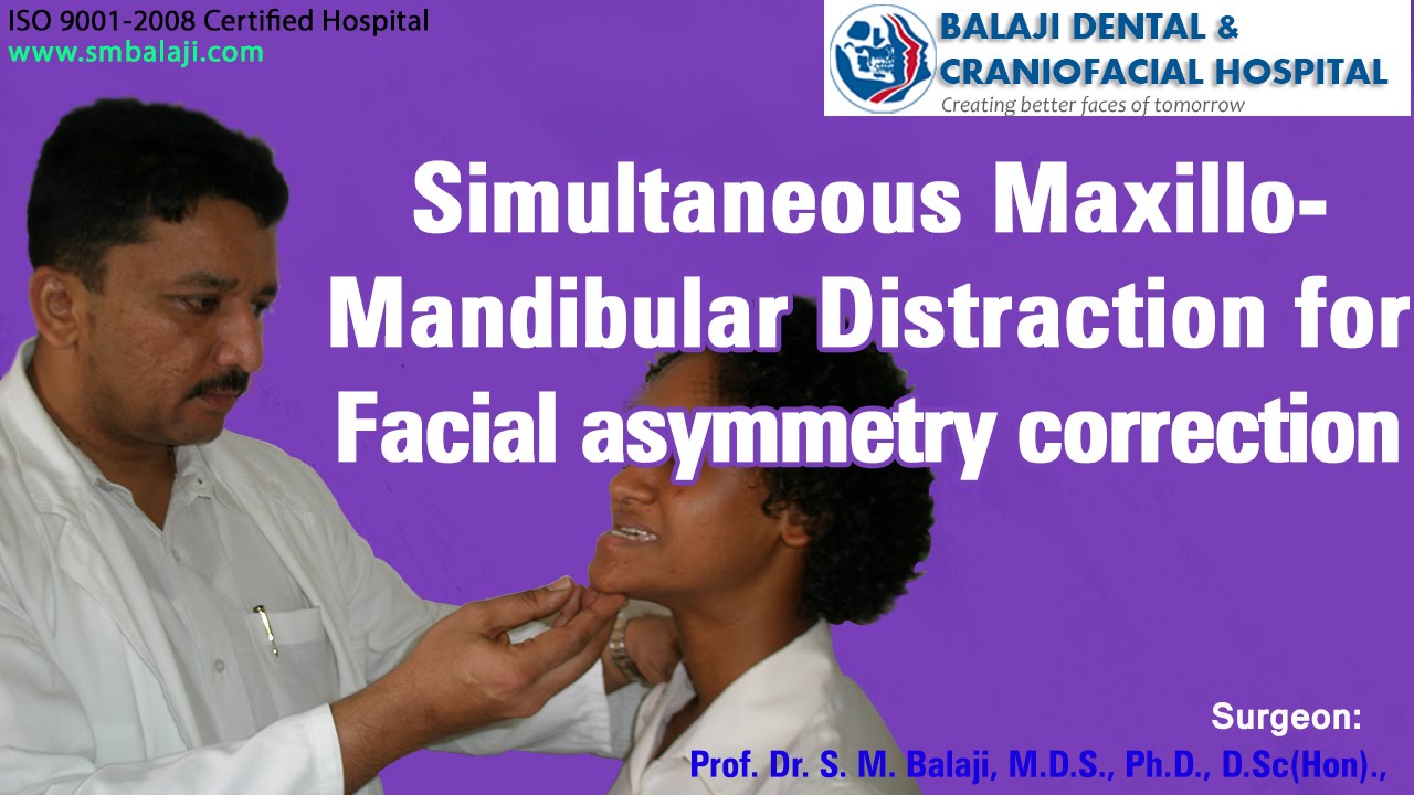 Simultaneous Maxillo-Mandibular Distraction for Facial asymmetry ...