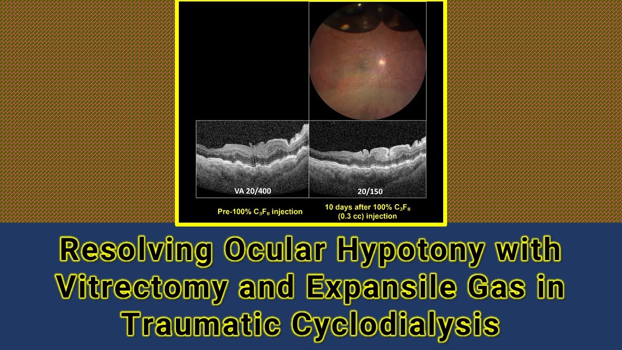V244 Resolving Ocular Hypotony with Vitrectomy and Expansile Gas in ...