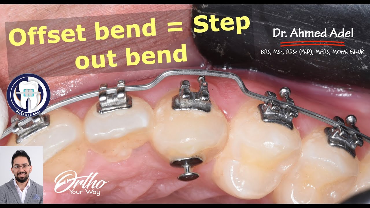 Orthodontic Wire Bending: Master The Offset Bend And Step-out Bend With ...