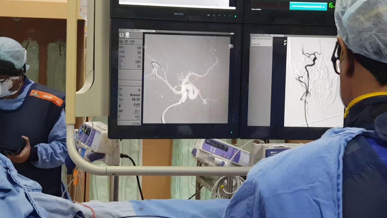 intracranial stenting- ICAD STENTING - YouTube
