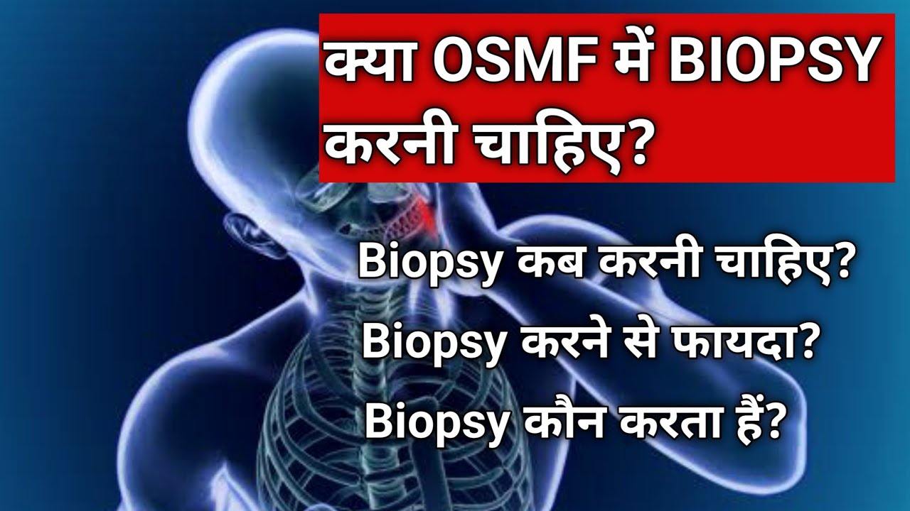क्या OSMF में Biopsy करना चाहिए। Biopsy for mouth cancer। Biopsy करना ...