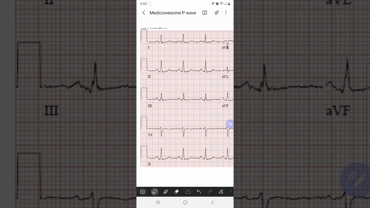 Hypernatremia Ecg