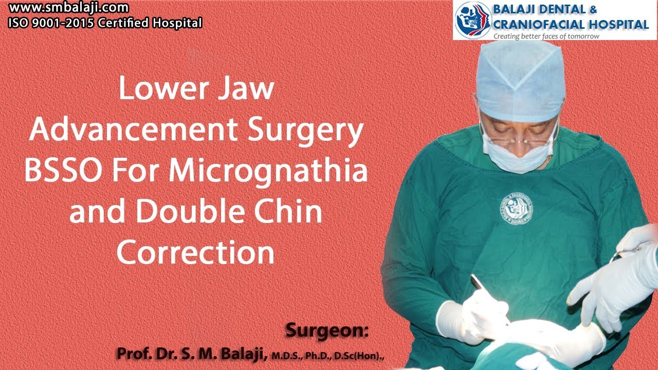 Lower Jaw Advancement Surgery BSSO For Micrognathia and Double Chin ...