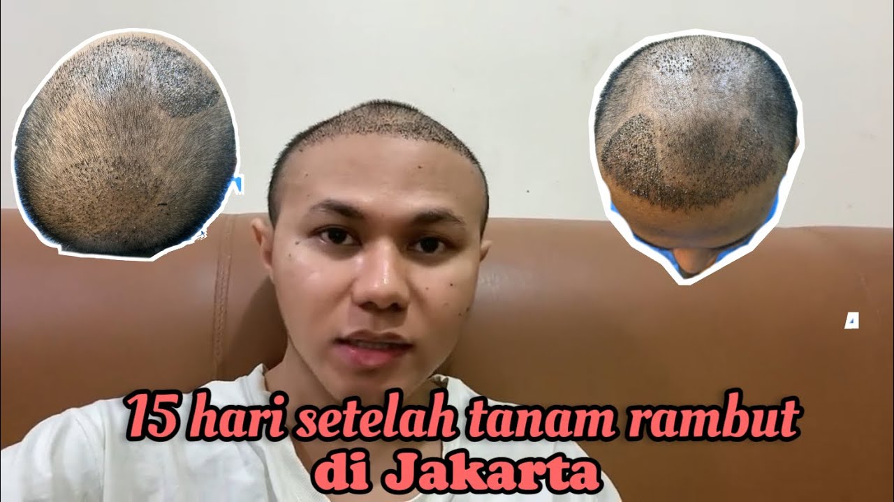 Hari ke 15 tanam rambut di Jakarta - YouTube