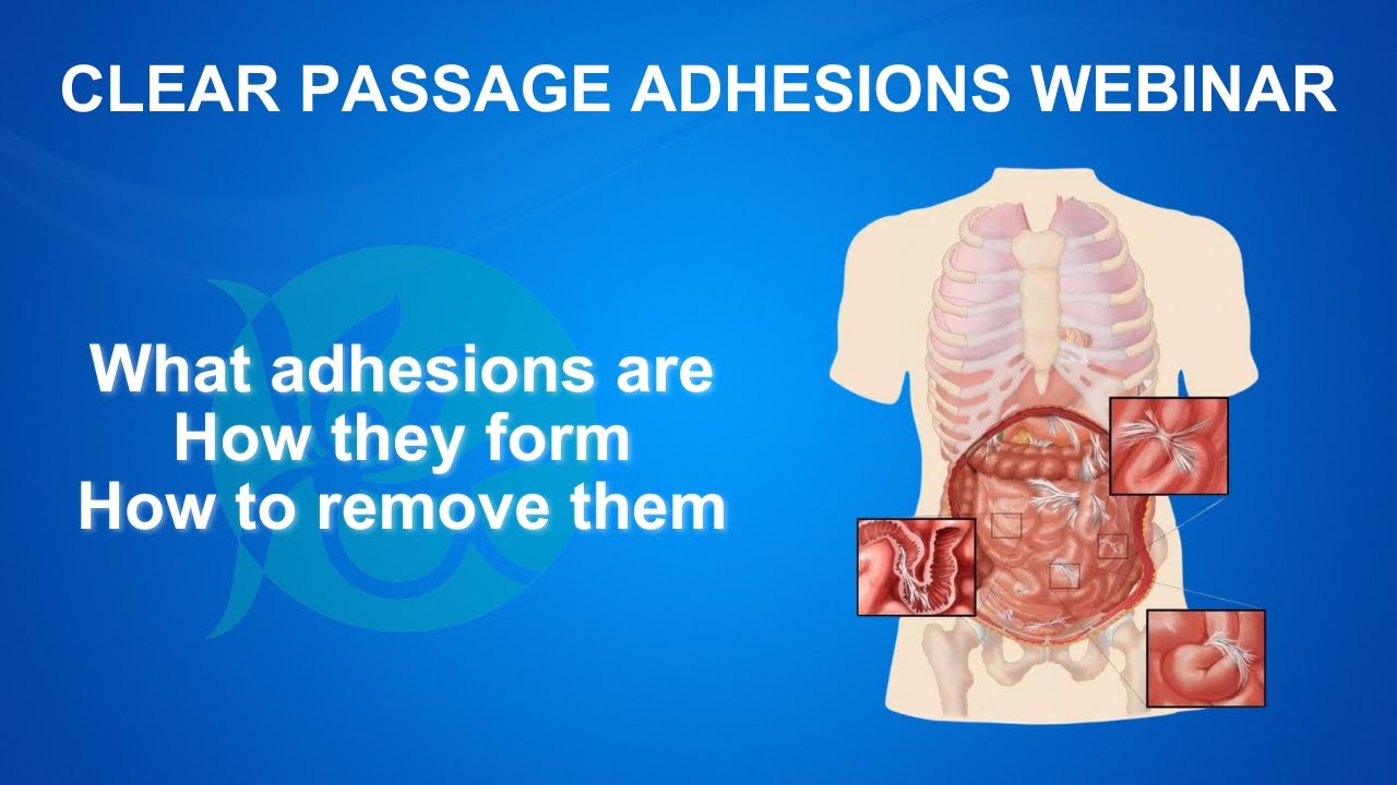 Adhesions Webinar: What They Are, How They Form & Natural Treatment ...