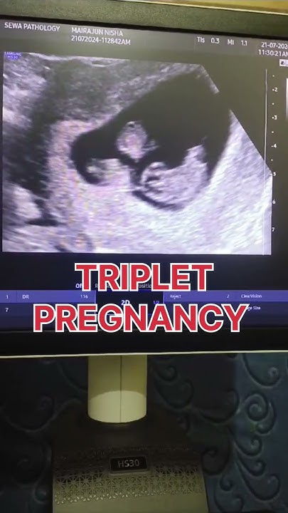 Triplet pregnancy ultrasound showing video #medical #baby #ultrasound #pregnant #biharcho #short ...