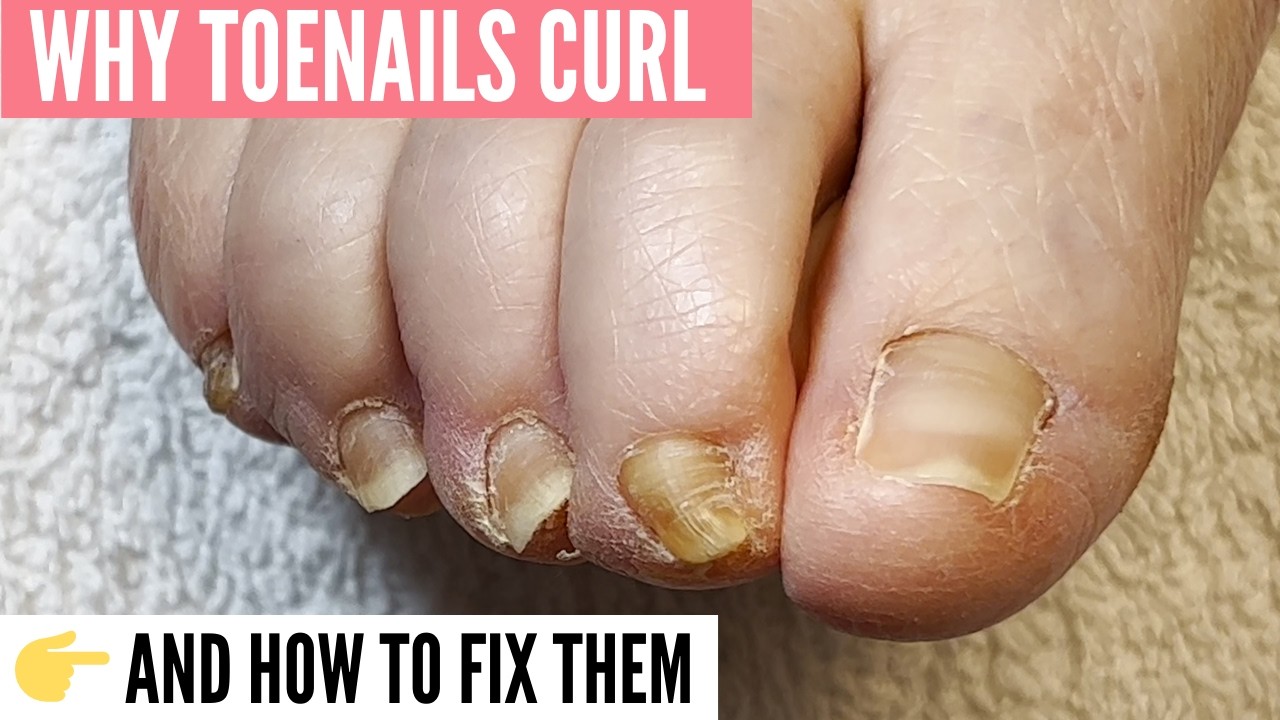 Why Toenails Curl 👉 AND How To Fix Them Tiny Ram's Horn Toenails ...