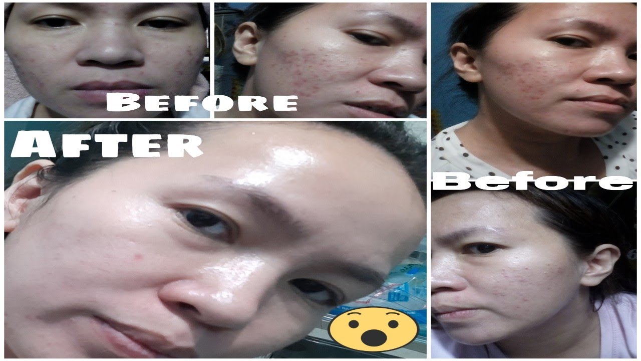 PAANO NAWALA ANG MGA PIMPLES KO (MY ACNE JOURNEY) PROVEN AND TESTED ...