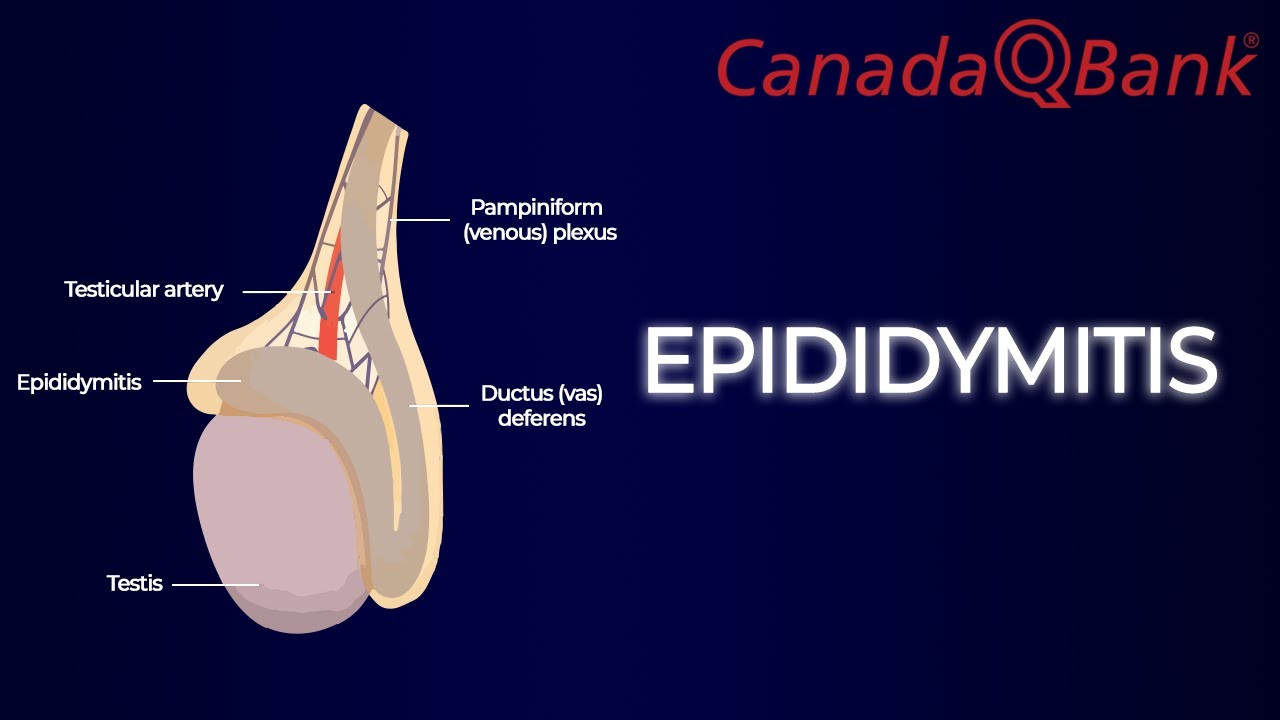 Epididymitis - YouTube