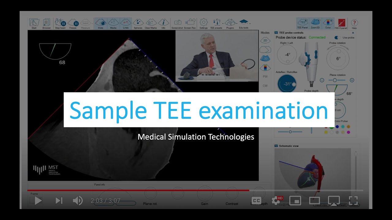 Sample TEE examination - interpret it yourself - YouTube