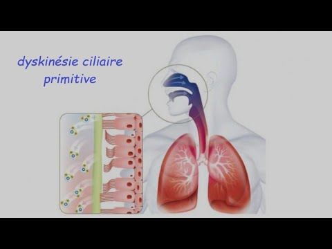 Comment intervenir face à la dyskinésie ciliaire primitive ? - YouTube