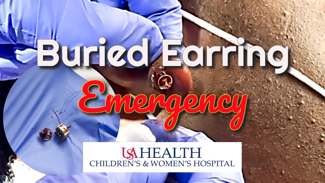 A Football Player's Buried Earring Emergency - YouTube