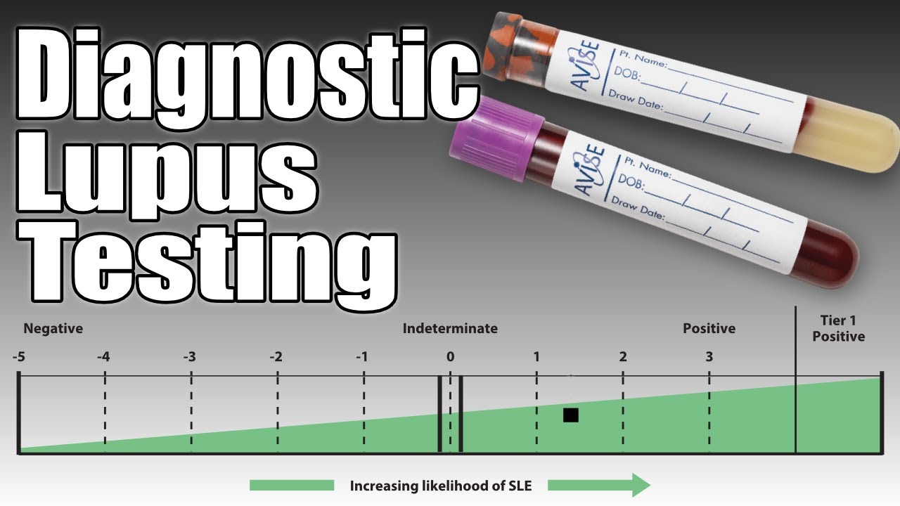 The Role of AVISE CTD in Lupus Diagnosis - YouTube