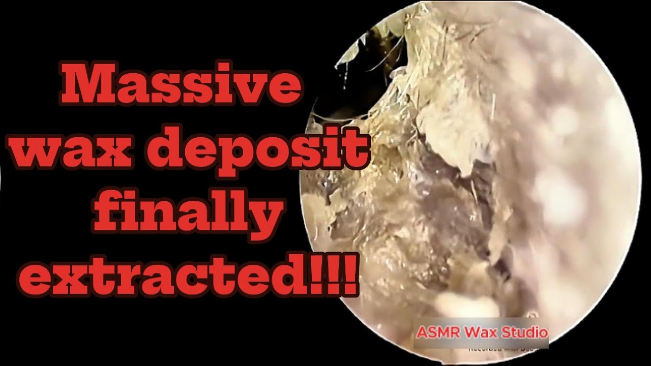 Massive wax deposit finally extracted | ASMR clean | relax | unwind ...