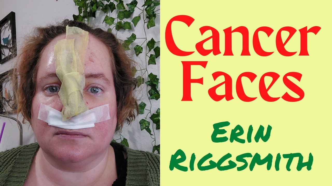 Cancer Faces- Erin Riggsmith's Journey with Basal Cell Carinoma Removal ...