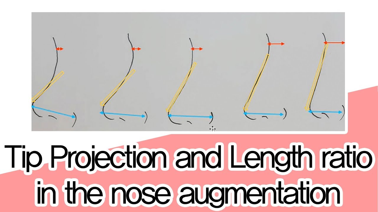 Tip Projection and Length ratio in the nose augmentation - YouTube
