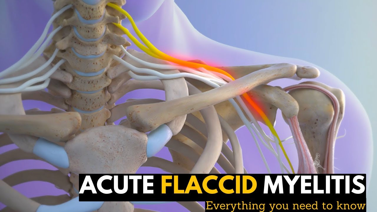 Acute Flaccid Myelitis: Everything You Need To Know - YouTube