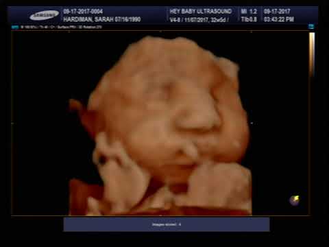isaac 3d ultrasound - YouTube