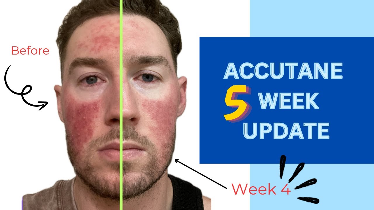 Accutane Week 5: Morning Skincare Routine - YouTube