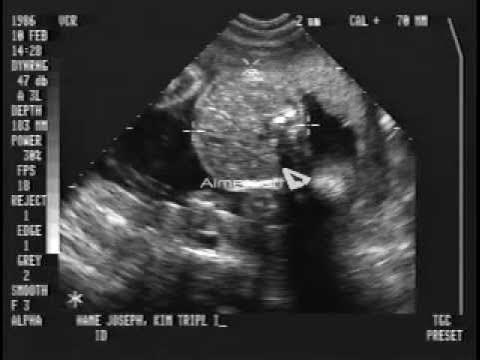 Philip-Kevin Ultrasound - March 3, 1987; March 17, 1987; March 31, 1987 - YouTube