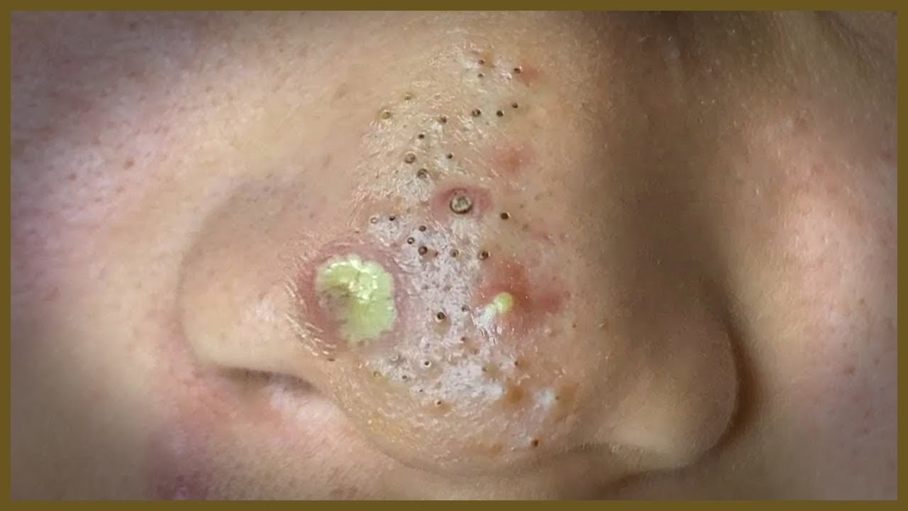 𝐍𝐞𝐰 𝐁𝐥𝐚𝐜𝐤𝐡𝐞𝐚𝐝 𝐑𝐞𝐦𝐨𝐯𝐚𝐥 𝐓𝐞𝐜𝐡𝐧𝐢𝐪𝐮𝐞 - YouTube