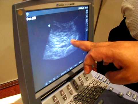 Basics of ultrasound guided regional anesthesia part I.AVI - YouTube
