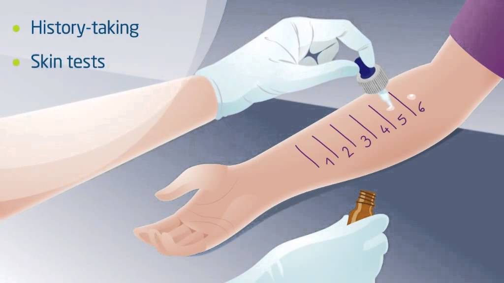 The diagnosis of allergic rhinitis - YouTube