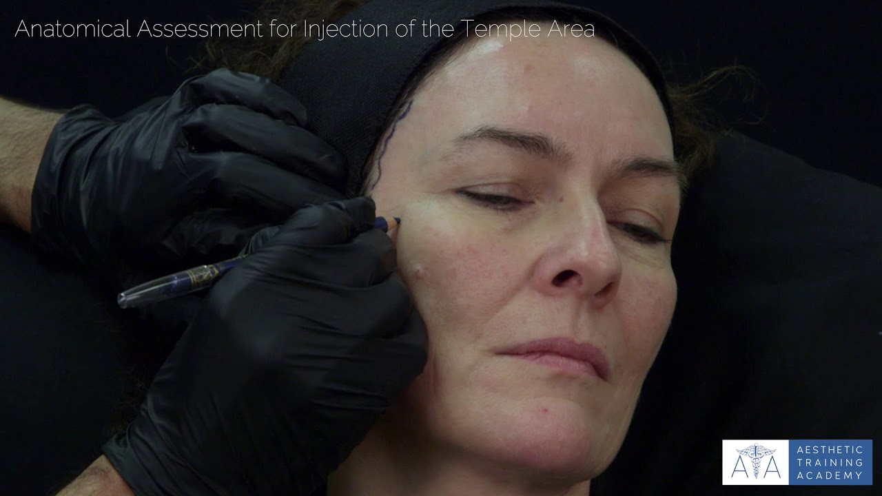 Anatomical Assessment for Injection of the Temple Area - YouTube