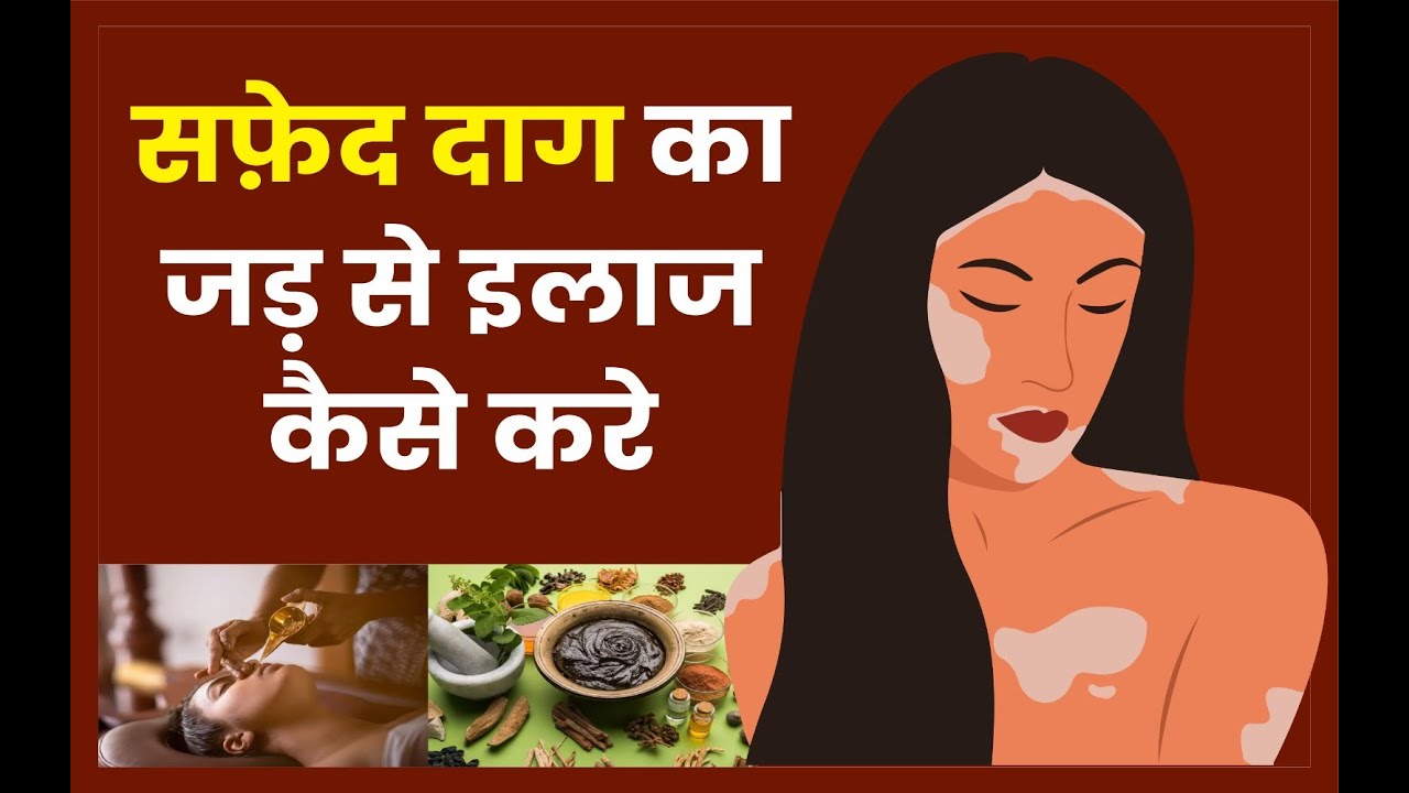 safed daag ka ilaj !SAFED DAAG KYO HOTA leukoderma -vitiligo safed daag ...