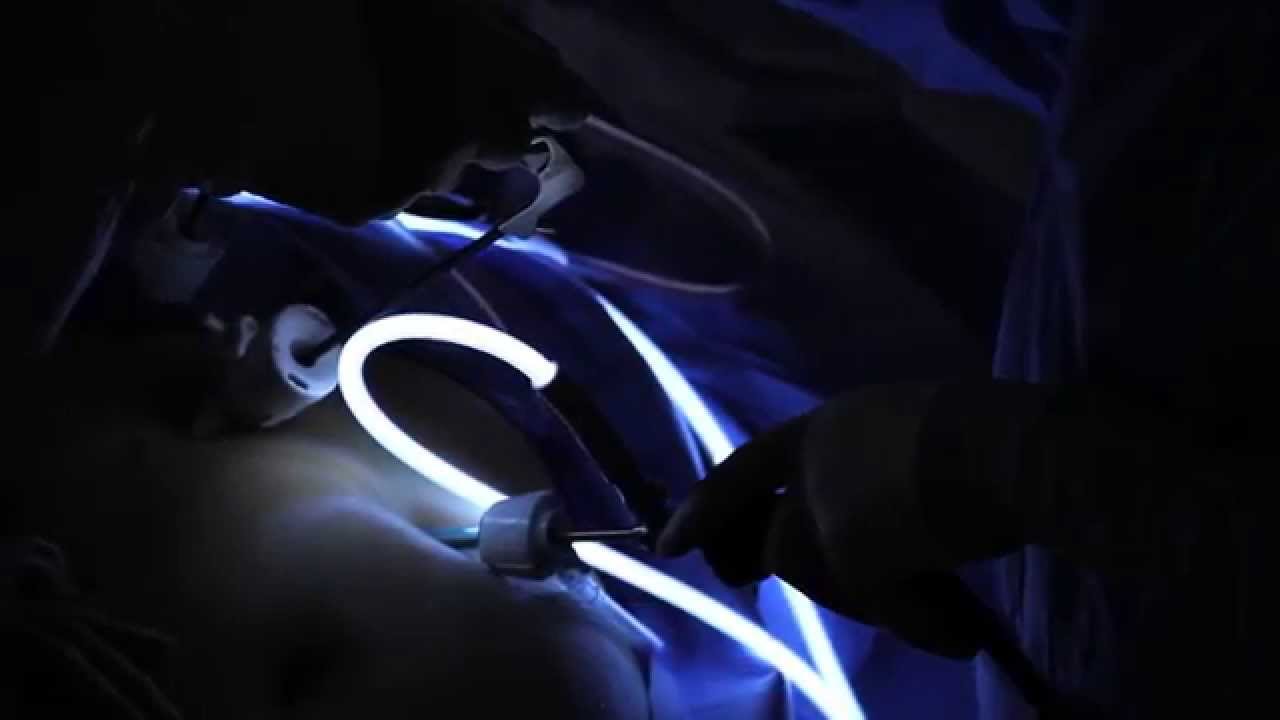 Heller Myotomy Surgical Procedure - YouTube