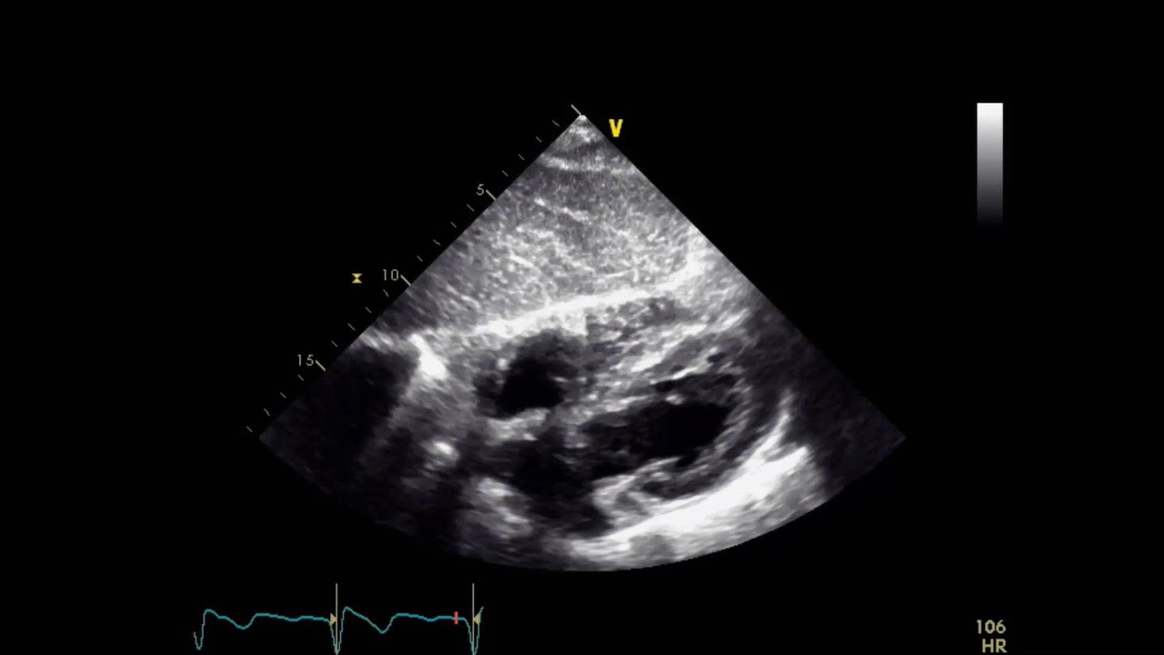 Echocardiogram in COVID-19 with pneumopericardium and pneumediastinum ...