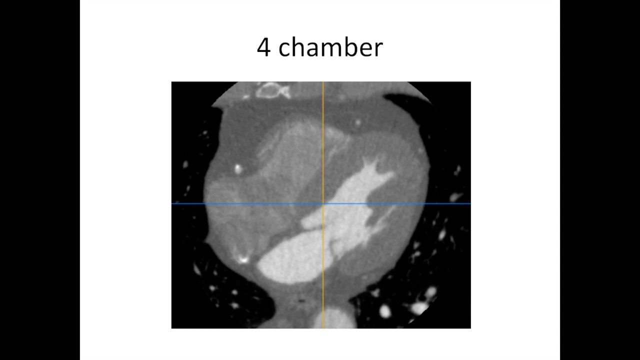 Cardiac anatomy for radiology - part 6 - standard views - YouTube