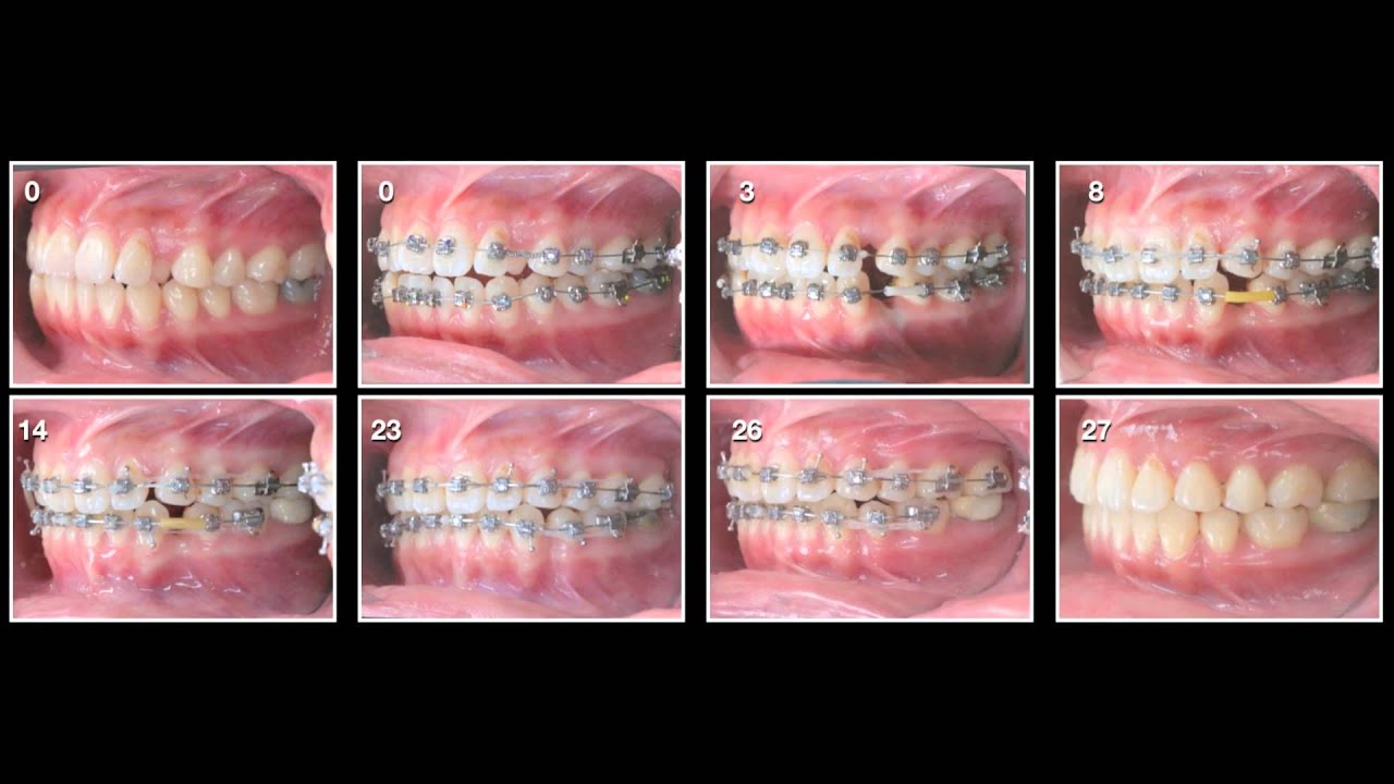 Premolar Substitution and ABO - YouTube