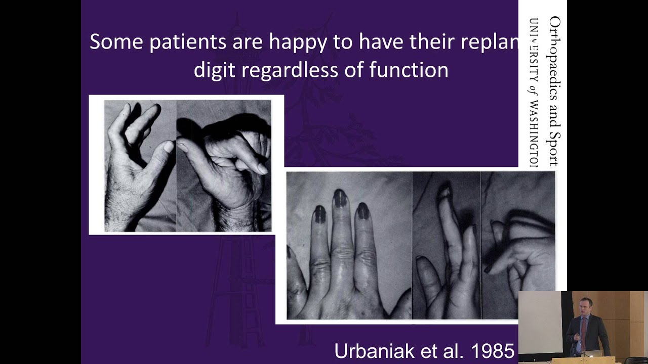 Orthopaedics and Sports Medicine - May 7th, 2014 - Finger Replantation ...
