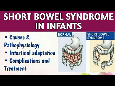 Short Bowel Syndrome Pediatrics | Short Bowel Syndrome Symptoms ...