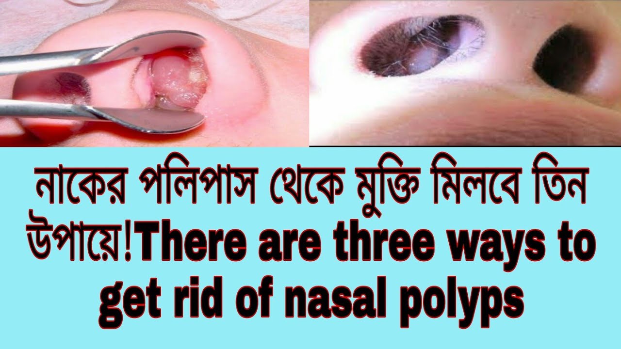নাকের পলিপাস থেকে মুক্তি মিলবে তিন উপায়ে! There are three ways to get ...