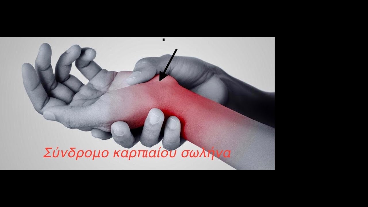 Ορθοπαιδικός Κοντολάτης. Σύνδρομο καρπιαίου σωλήνα - YouTube