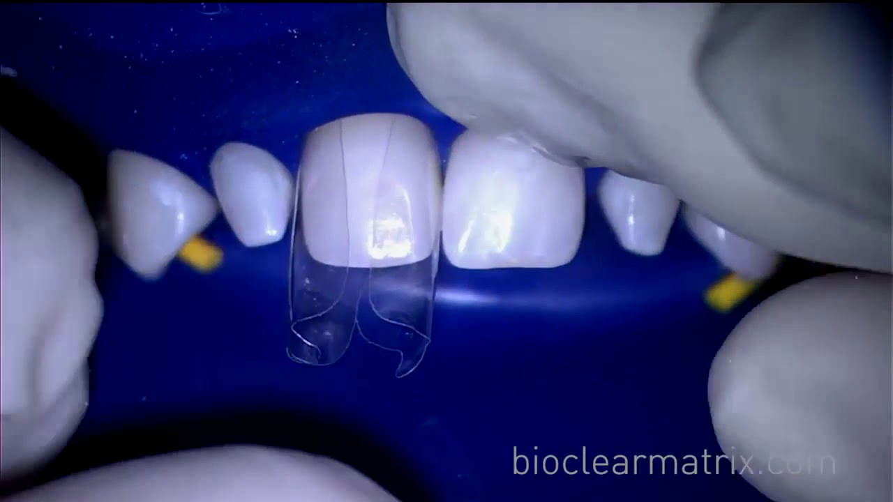 Bioclear Composite Veneers for Undersized Teeth Part 1 - YouTube