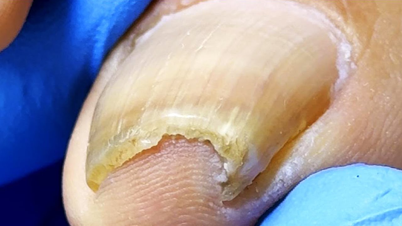 Super curly toenails, perfectly trimmed nails~【Xue Yidao】 - YouTube